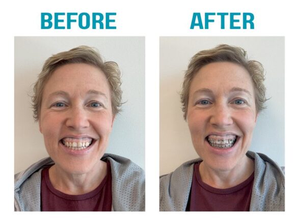 The Big Braces Reveal! – Novakistan